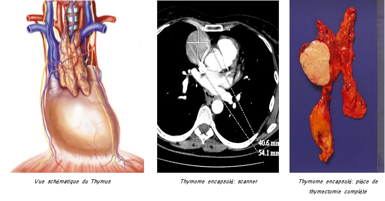 Infos patients - Chirurgie Thoracique - IMM | Institut Mutualiste ...